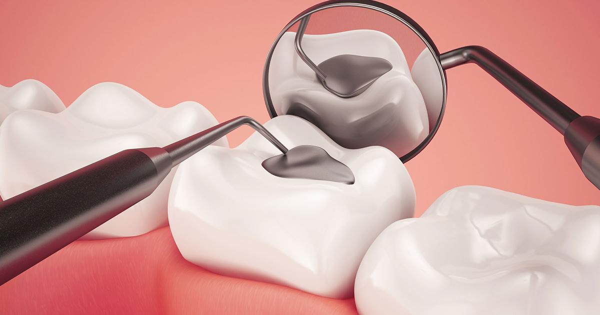 Care sunt diferențele dintre încrustație și plomba dentară? | DentExpert